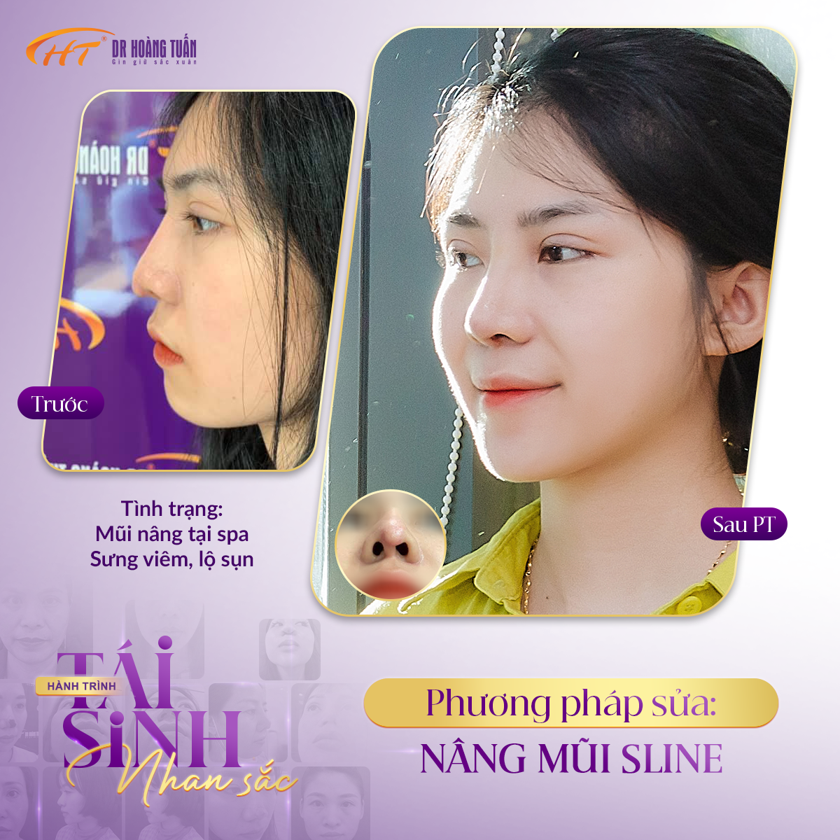 QUY TRÌNH PHẪU THUẬT THẨM MỸ AN TOÀN TẠI DR HOÀNG TUẤN