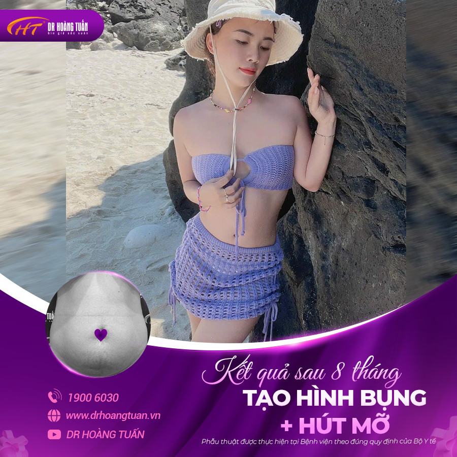 Tạo hình thành bụng: Quy trình và Kết quả